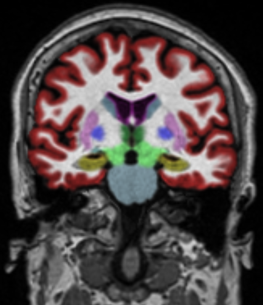 MRI Brain Imaging with NeuroQuant® for Dementia Assessment - Asiamedic ...